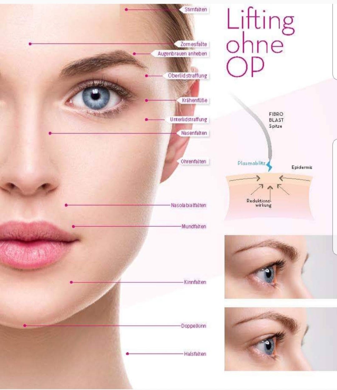 Byonik Laser Centrum - Fibroblast